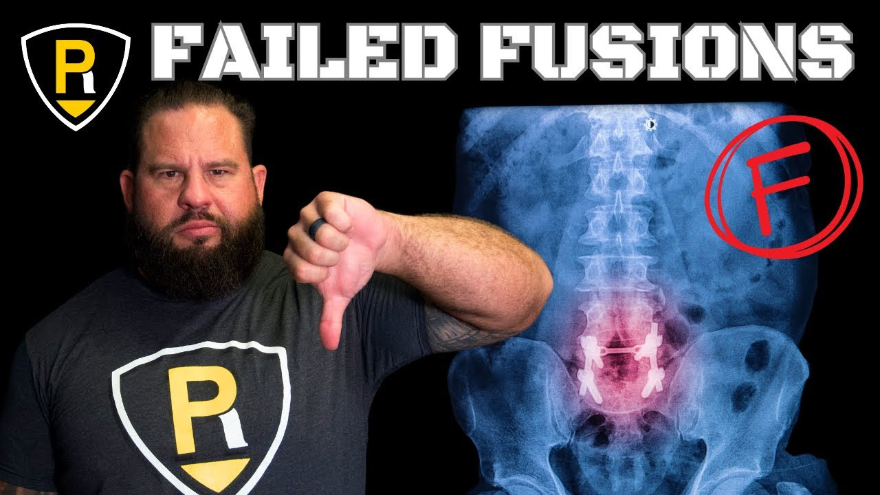 Why Spinal Fusions FAIL (DON'T MAKE THIS MISTAKE!)