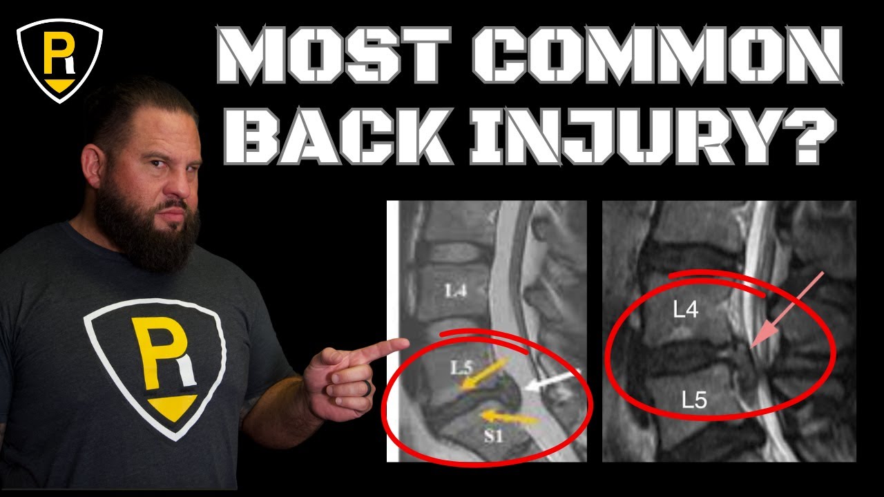 Understanding L4/L5 and L5/S1 Disc Herniations